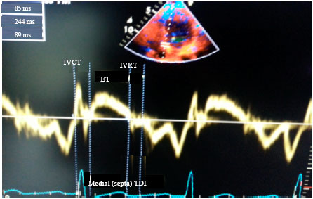 Role of Tissue Doppler Echocardiography in the Diagnosis of Subclinical ...