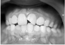 Root Fracture of an Immature Permanent Tooth with Open Apex: A Case Report
