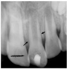 Root Fracture of an Immature Permanent Tooth with Open Apex: A Case Report
