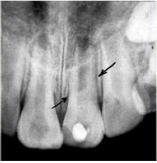 Root Fracture of an Immature Permanent Tooth with Open Apex: A Case Report