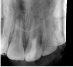 Root Fracture of an Immature Permanent Tooth with Open Apex: A Case Report