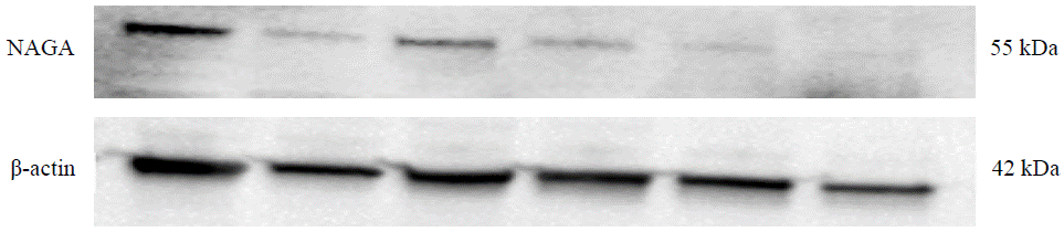 Comparative Study on the Role of Nagalase Expression in Different ...