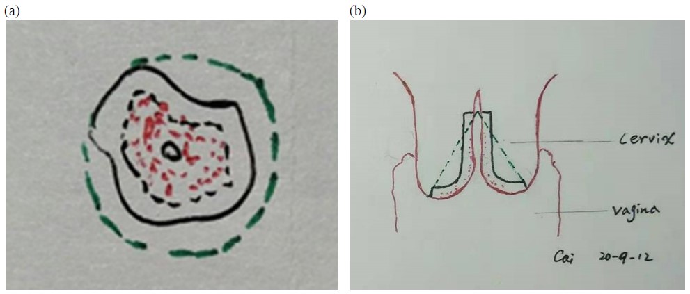 Efficacy and Security of Improved Thumbtack-Type Cervical Cold Knife ...