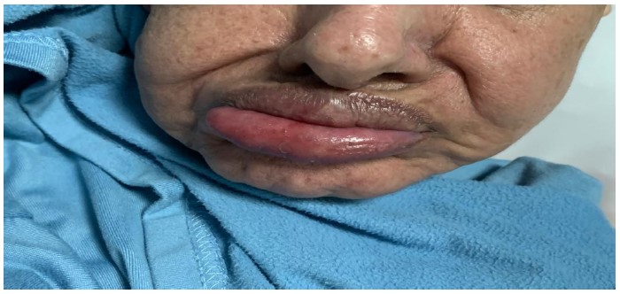 Levetiracetam-Induced Acute Hypersensitivity Reaction in a Previously ...