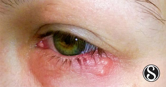 Prevalence, Biofilm Formation and Anti-microbial Susceptibility Testing ...