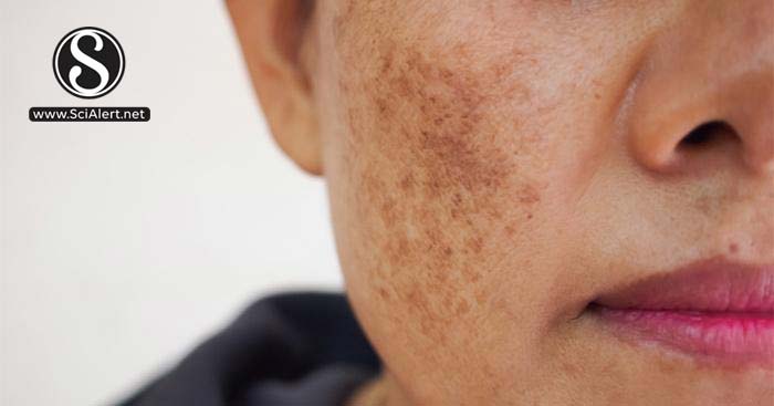 Efficacy of Micro-Needling with Topical Vitamin C and E Serum Versus ...