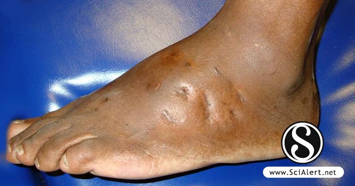 Characterization of Foot Mycetoma Using Sonography and Color Doppler ...