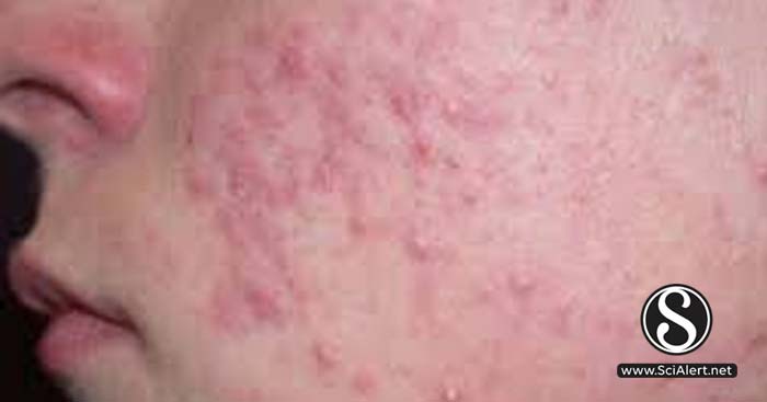 Demodex Mites in Relation to the Degree of Acne Vulgaris among Egyptian ...