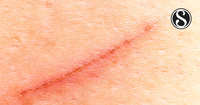 Lower Uterine Scar Thickness Predicts Timing of Next Cesarean Section ...